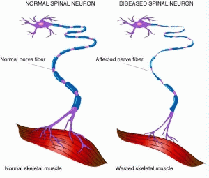 Amyotrophic Lateral Sclerosis – EMG